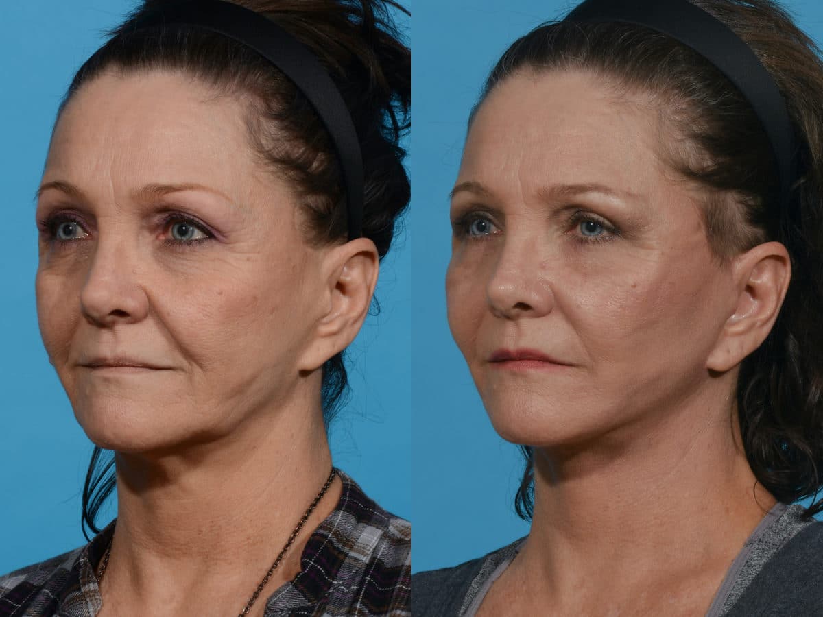 Facelift - Southlake Plastic Surgery